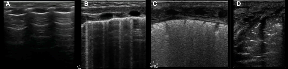POCUS Lung | NicuPocus