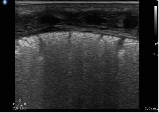 POCUS Lung | NicuPocus